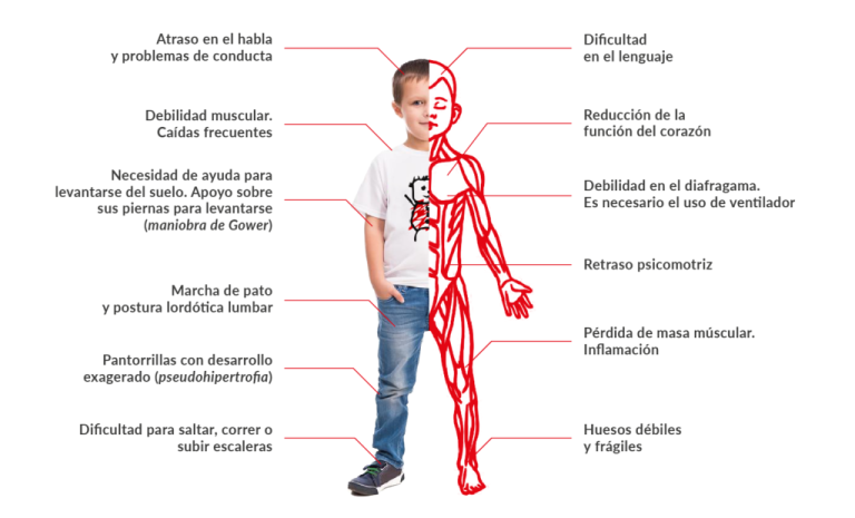 DISTROFIA MUSCULAR - Centro Médico Respirar